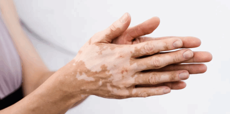 Early Vitiligo Signs and When to Consult a Dermatologist